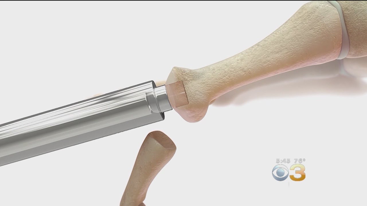 New Surgical Implant Helping Women With Foot Pain From High Heels - YouTube