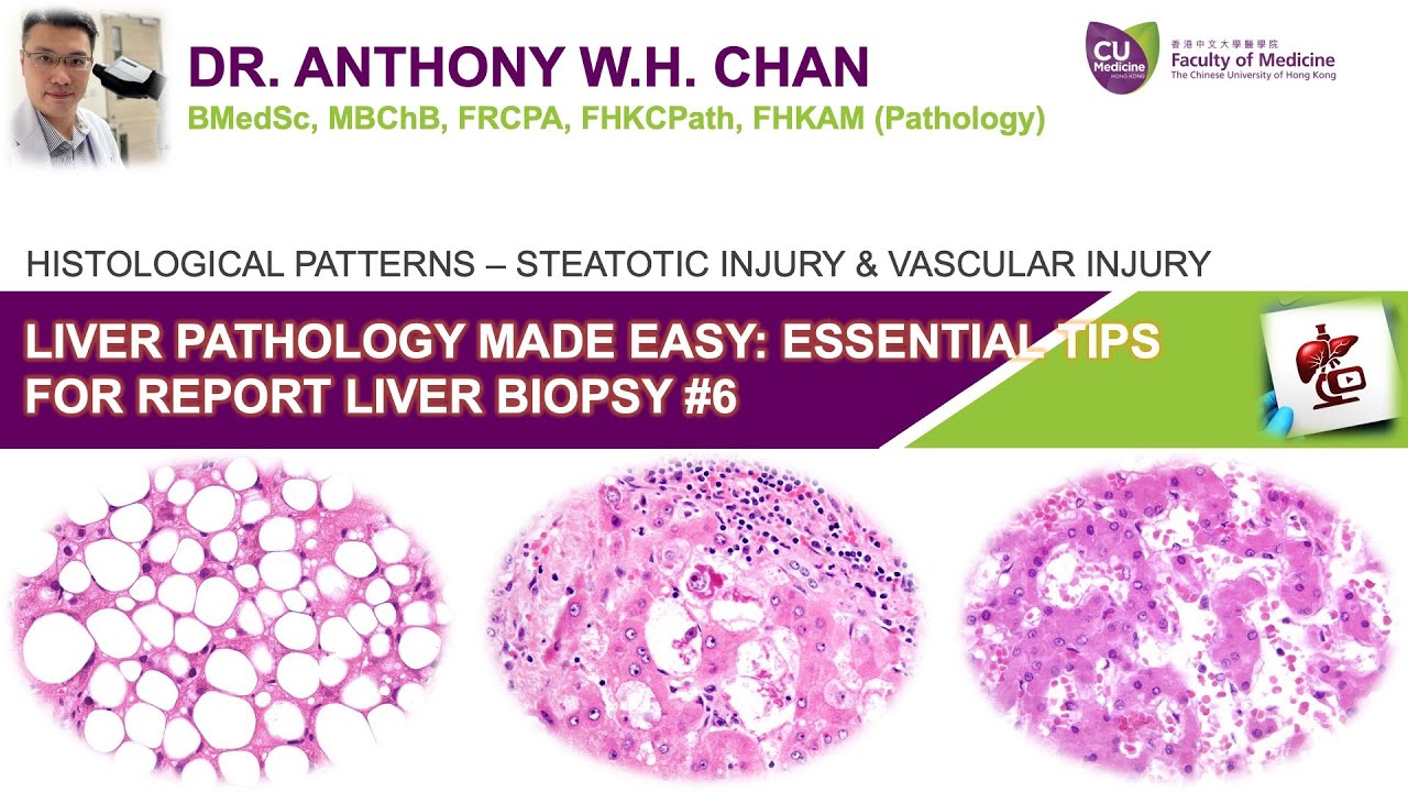 Liver Pathology Made Easy (6/7) - Essential Tips for Reporting Medical ...