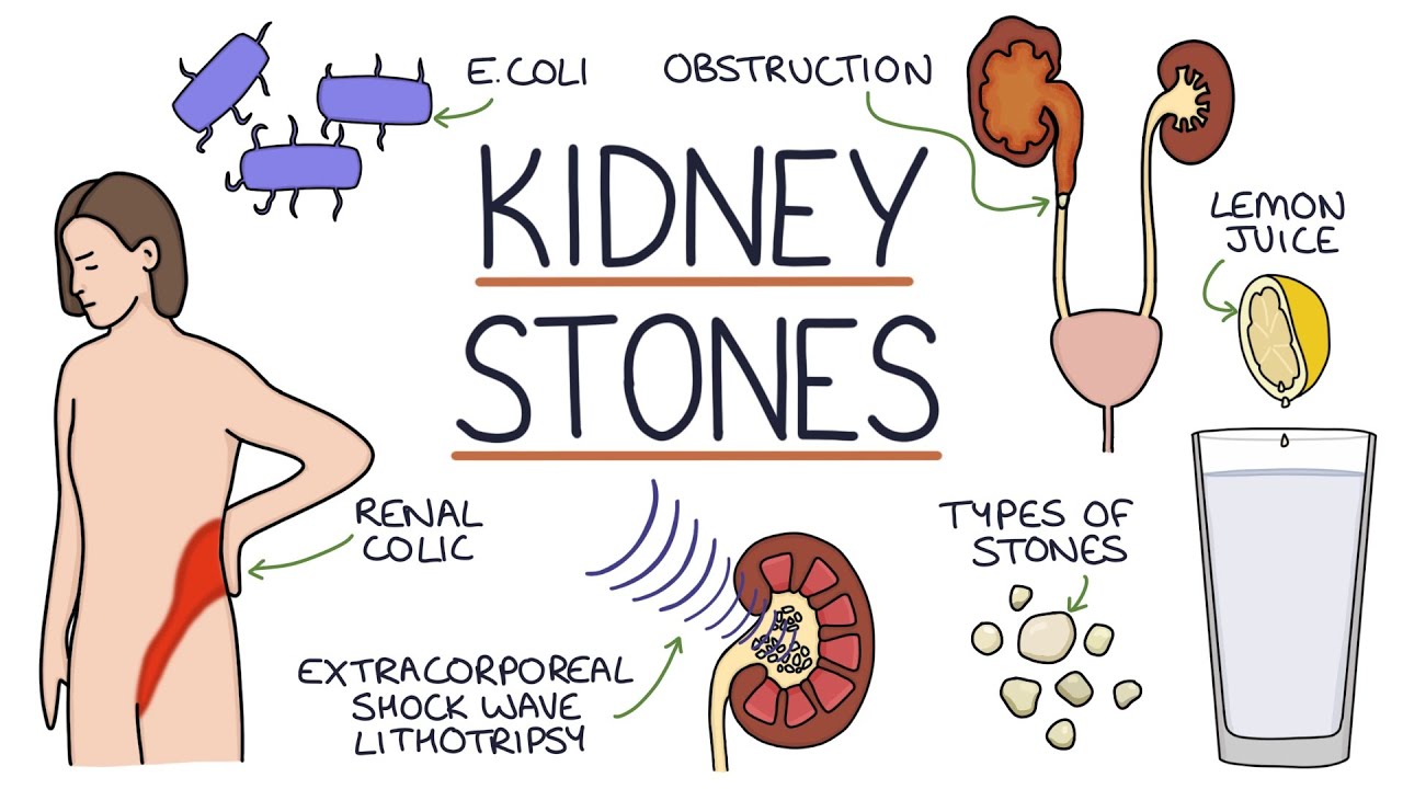 Understanding Kidney Stones YouTube