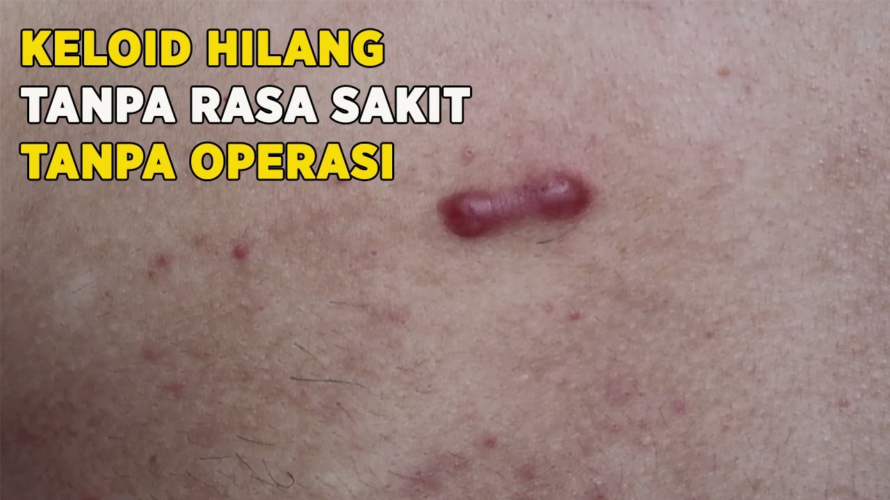 Cara Mudah Menghilangkan Keloid - YouTube