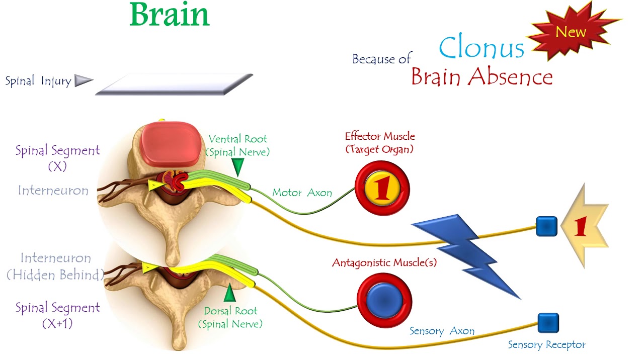 Clonus 2, Second Hypothesis of Pathophysiology - YouTube