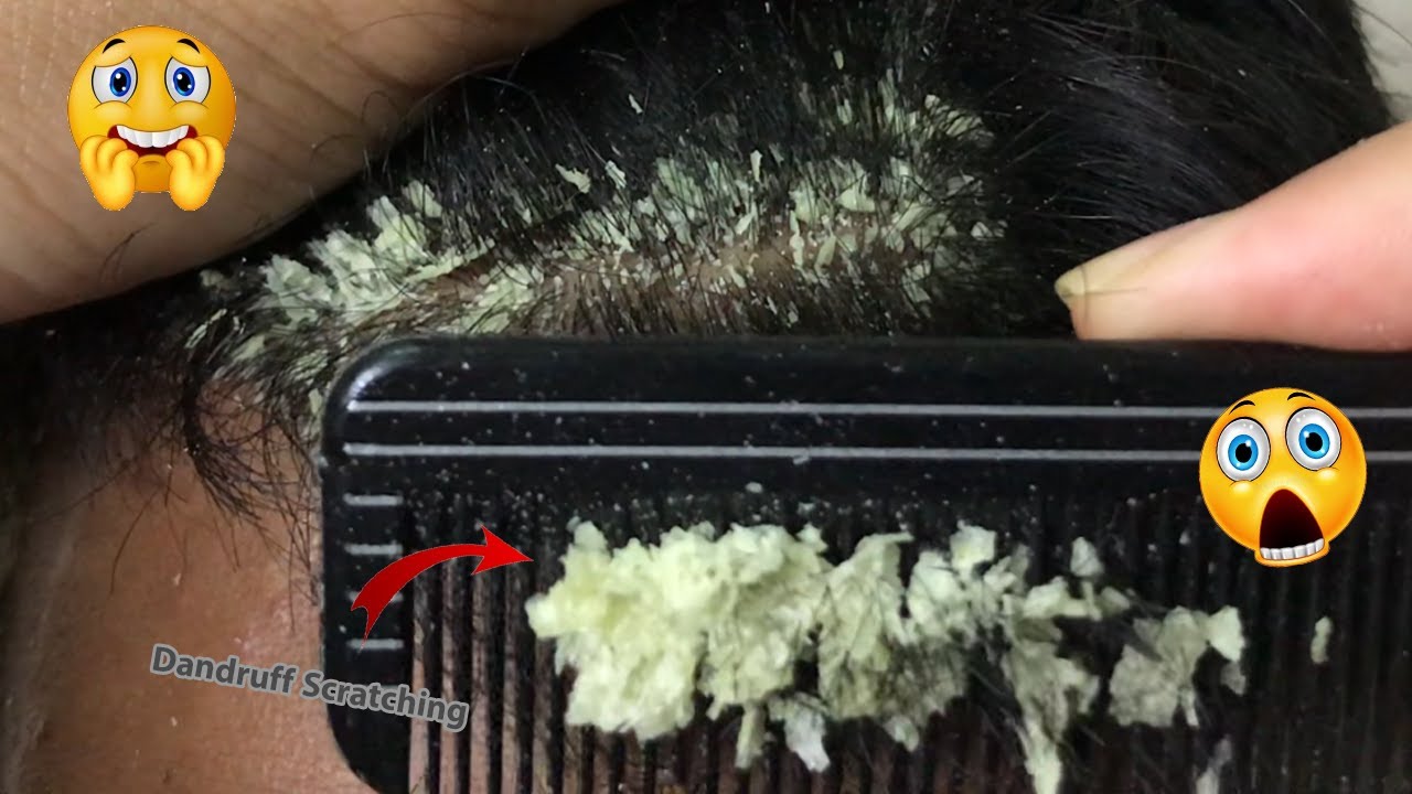 Big flakes || Dandruff Scratching Scalp || Itchy Dry Scalp Treatment ...