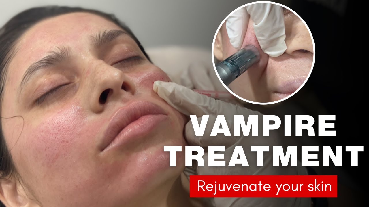 Vampire Facial:The Bollywood Secret to Flawless Skin - YouTube