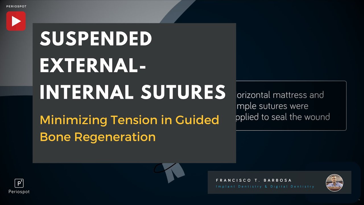 Suspended External-Internal Sutures: Minimizing Tension in Guided Bone ...