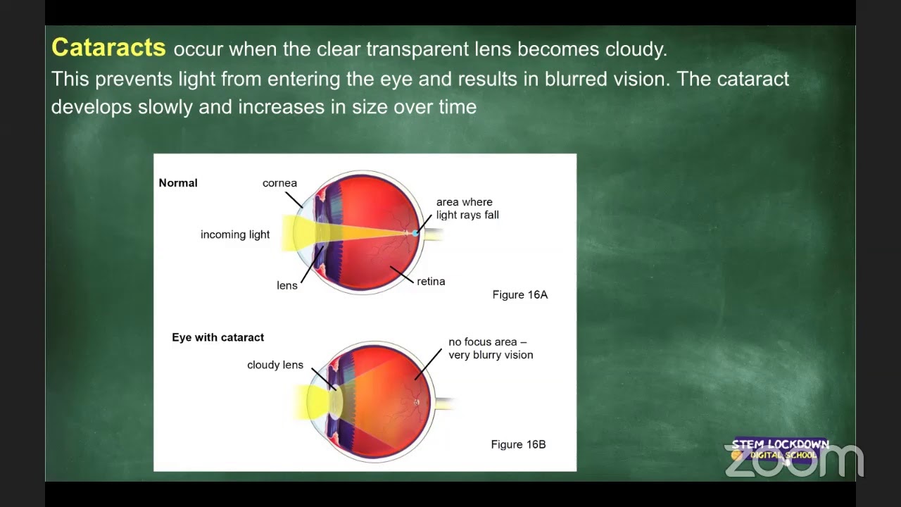 Grade 12 - Life Science | Vision and defects of the eye - YouTube