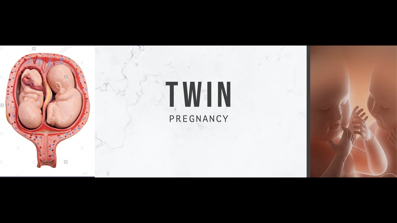 MULTIPLE PREGNANCY Twin Pregnancy Unit 7 OBG HIGH RISK PREGNANCY multiple-pregnancy-twin-pregnancy-unit-7-obg-high-risk-pregnancy