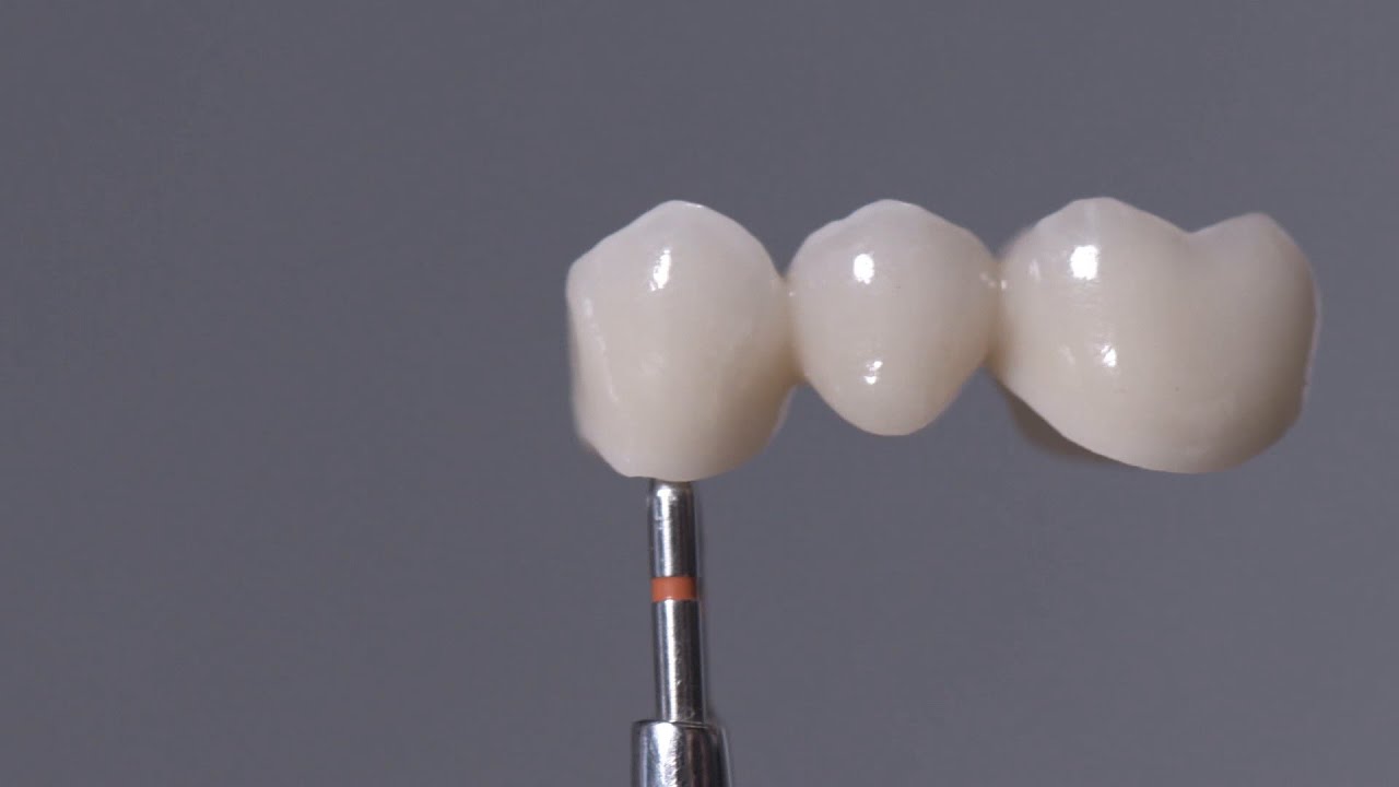 Allceramic Cercon ht Fully Veneered Celtra Ceram - YouTube