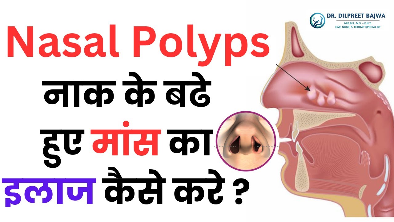 Nasal Polyps - नाक के बढे हुए मांस का इलाज कैसे करे || Nasal Polyps ...