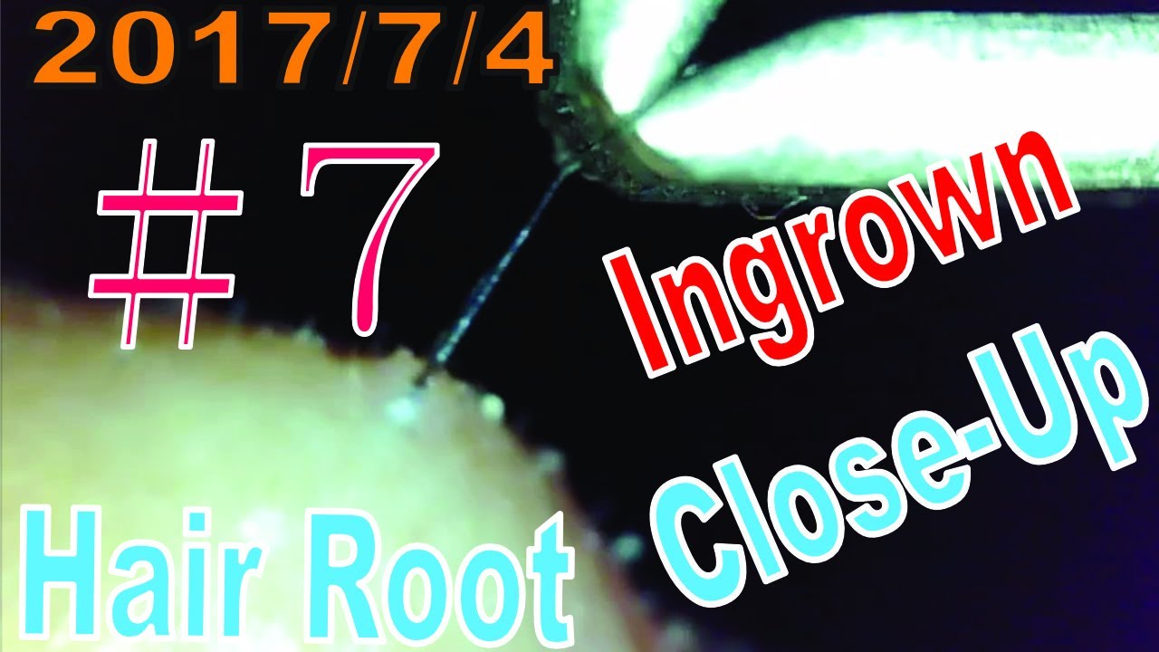 Hair Root / Root Sheath Close Up ＃7【Ingrown & Dead】 - YouTube