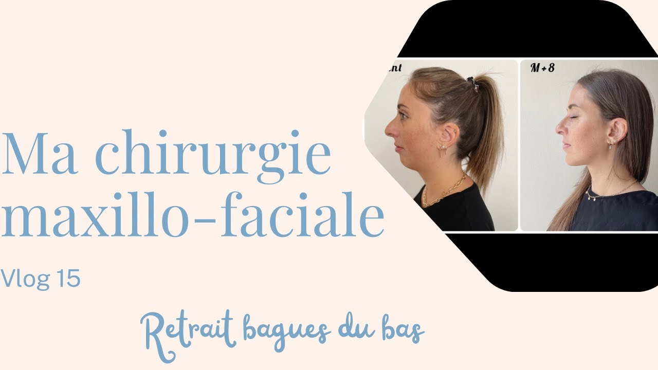 Ma chirurgie maxillo-faciale - Vlog 15 - Suivi post opératoire - retrait des bagues linguale ...