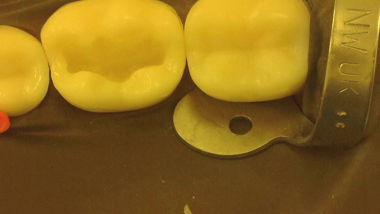 Class I Composite Restoration - YouTube