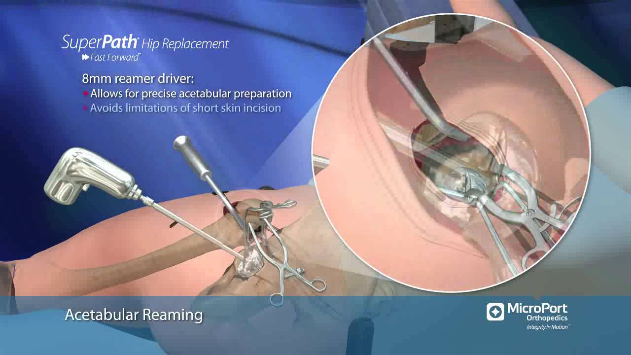 Особенности хирургической техники SuperPath (MicroPort Orthopedics) - YouTube