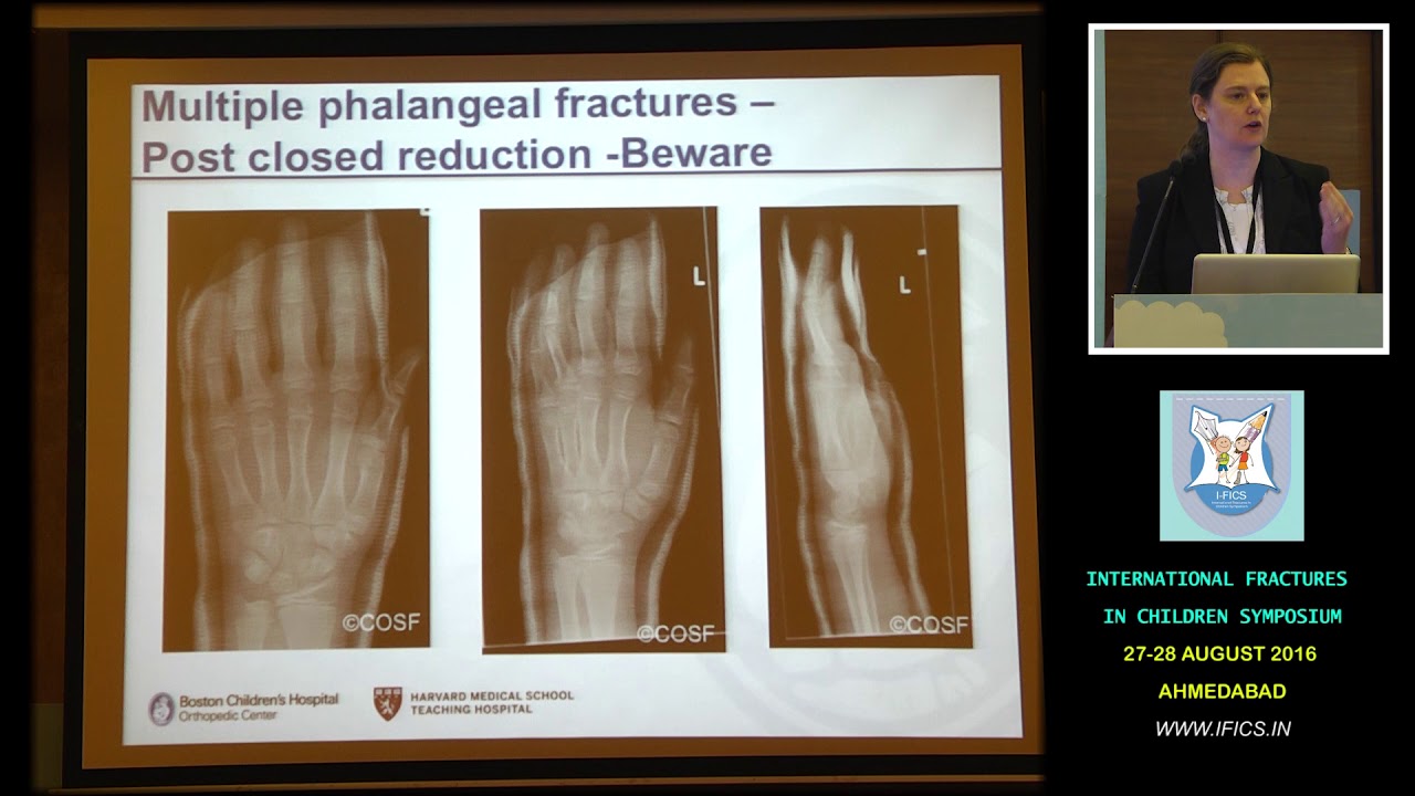 Hand Fractures in Children - Carley - IFICS 2016 - YouTube