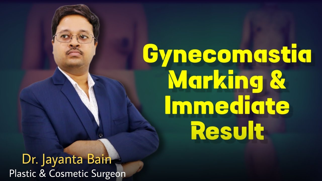 Gynecomastia Marking & Immediate Result | Dr. Jayanta Bain Plastic ...