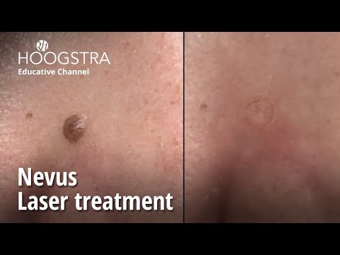 Nevus - Laser treatment - 22297 - YouTube
