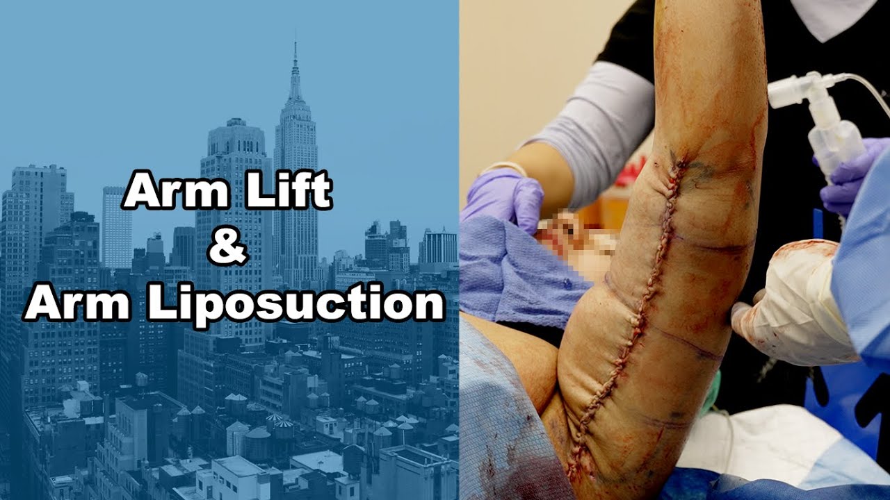 Re-Shaping the Arms: Arm-Lift & Arm Liposuction - YouTube