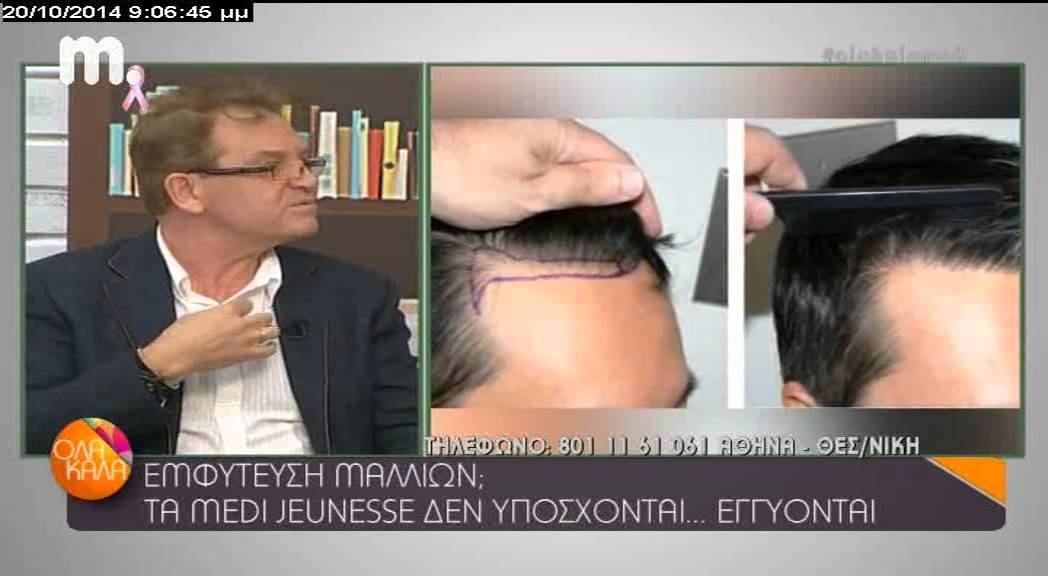 Εμφύτευση μαλλιών - Νέα μέθοδος 1 - YouTube