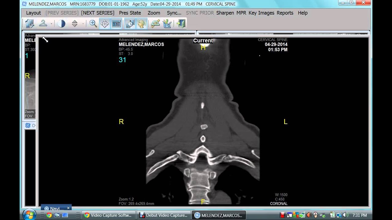 Cervical Spine CT SCAN - YouTube