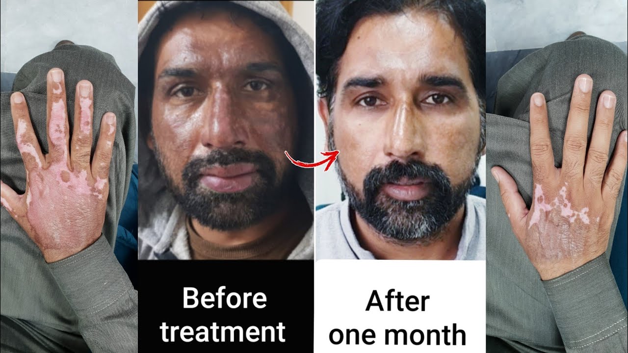 face burn treatment - YouTube