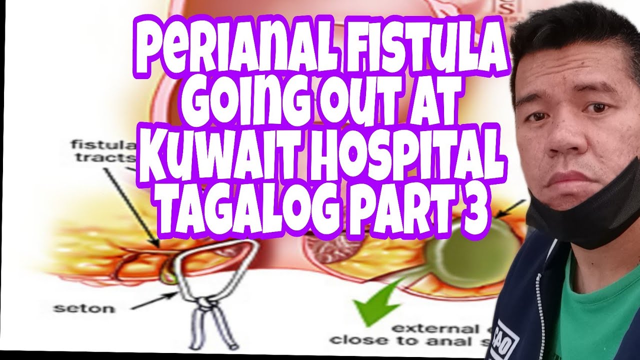 Perianal Fistula Seton Placement. Tagalog Part 3. - YouTube