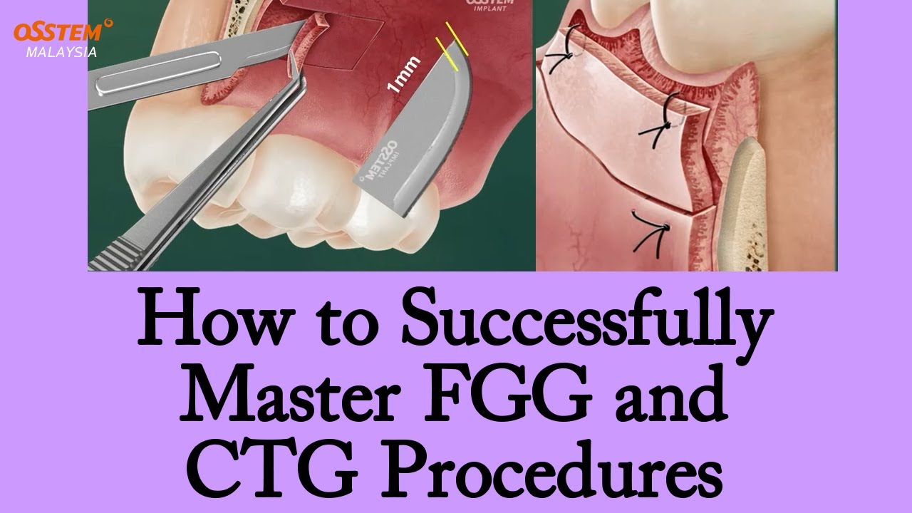 Surgery Series 3(4): How to Successfully Master FGG and CTG Procedures ...