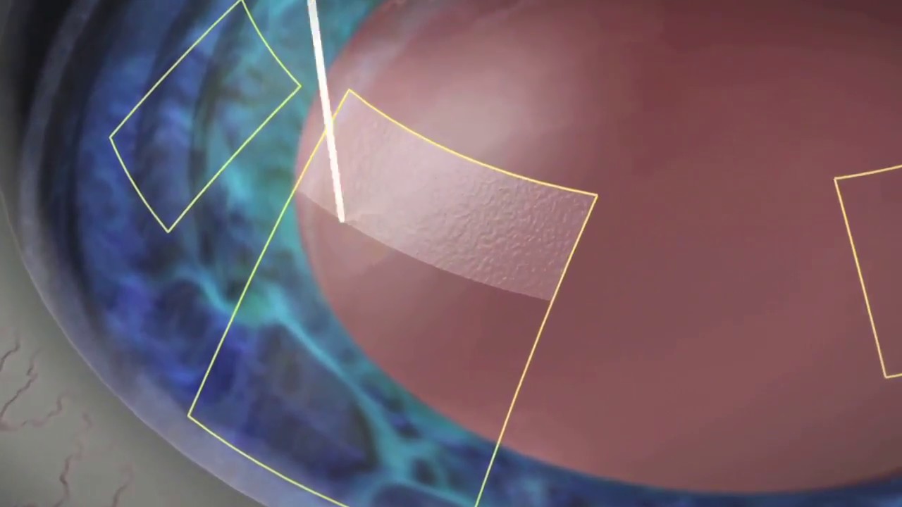 Femtosecond cataract surgery by LenSX - YouTube