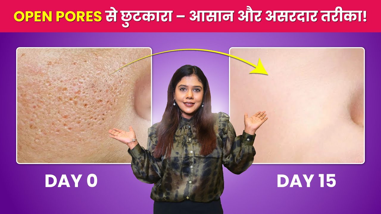 Open Pores Ka Permanent Solution? | How to treat OPEN PORES | Open ...