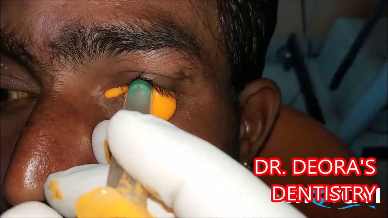 DEFINITIVE IMPRESSION FOR CUSTOM OCULAR PROSTHESIS - YouTube