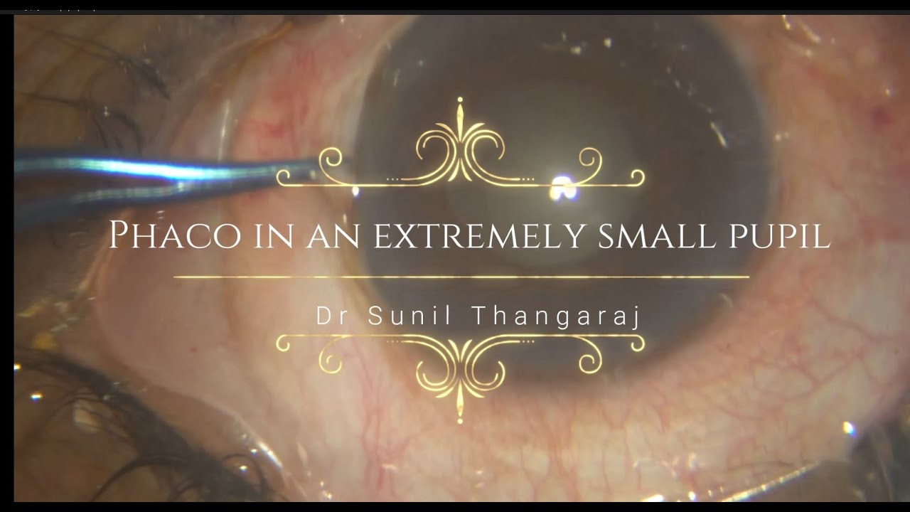 Performing phaco in an extremely small pupil without expansion device ...