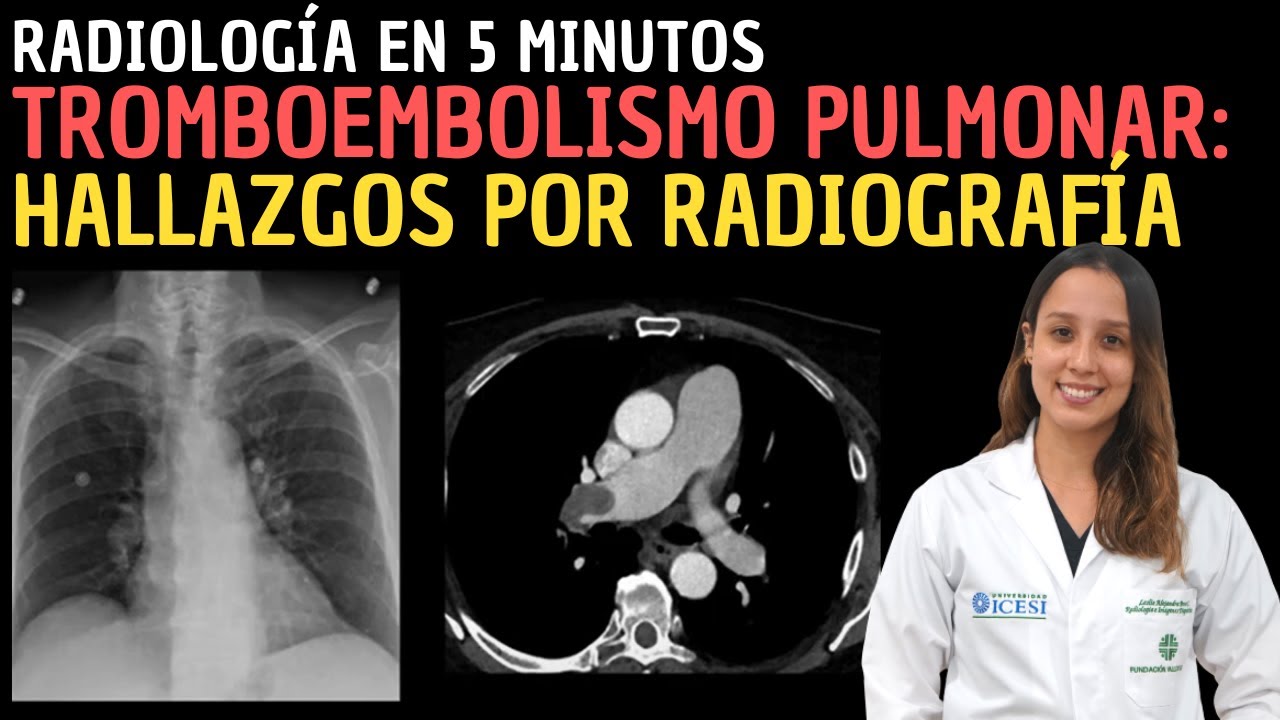 Radiología en 5 minutos: Tromboembolismo pulmonar: Hallazgos por ...