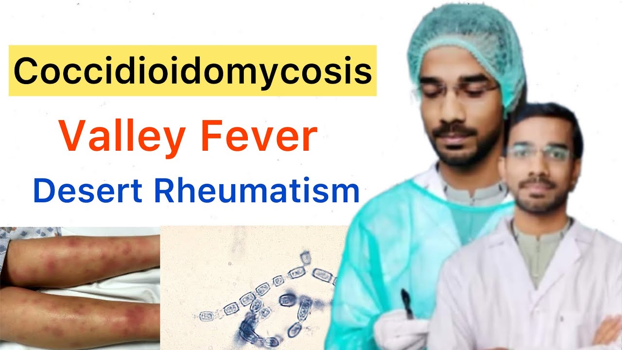 Coccidioidomycosis | Pathogenesis | Epidemiology | Clinical | Lab ...