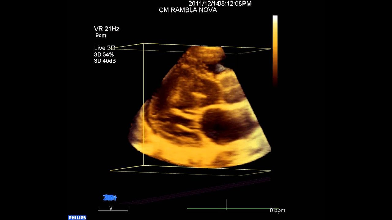 Ecocardiografía 3D - YouTube