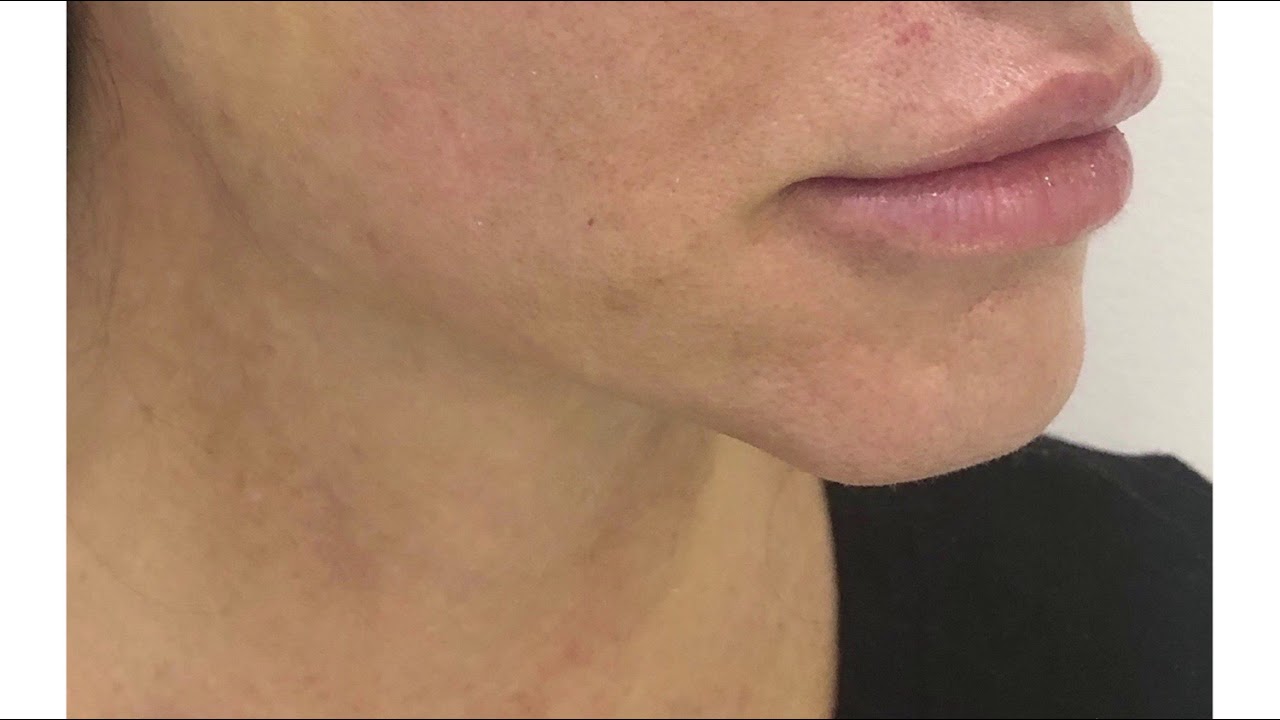 MINT / PDO Thread lift - Before After 02 - Beverly Hills Plaza Medi Spa ...