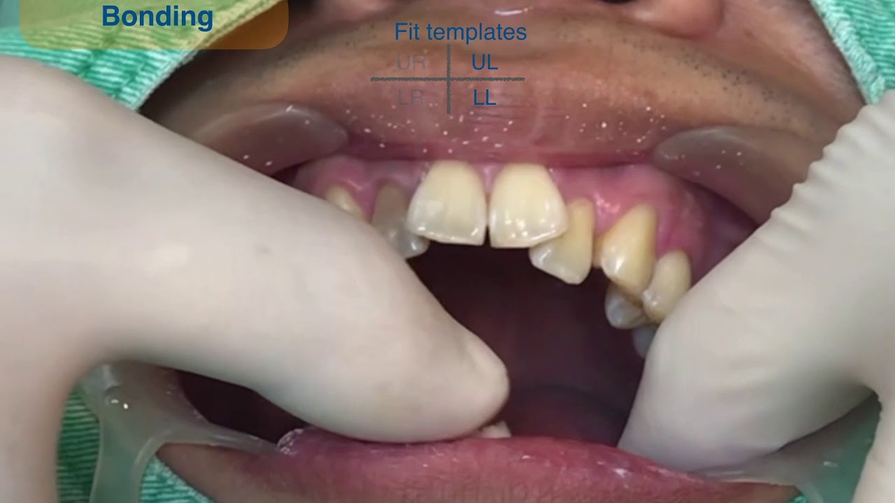 Efficient aligner attachment bonding procedure｜【Chris Chang Ortho】CC523 ...