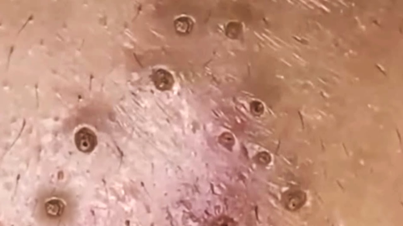 Satisfying Acne and Pimple Removal Blackheads & Whiteheads #1274 - YouTube