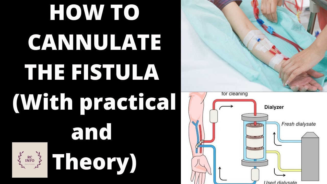 How to cannulate the fistula (Practical & Theory)/ How to cannulate ...