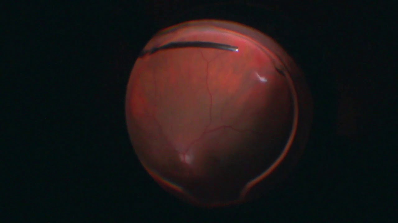 Patient Education: Floaters in the Eye. - YouTube
