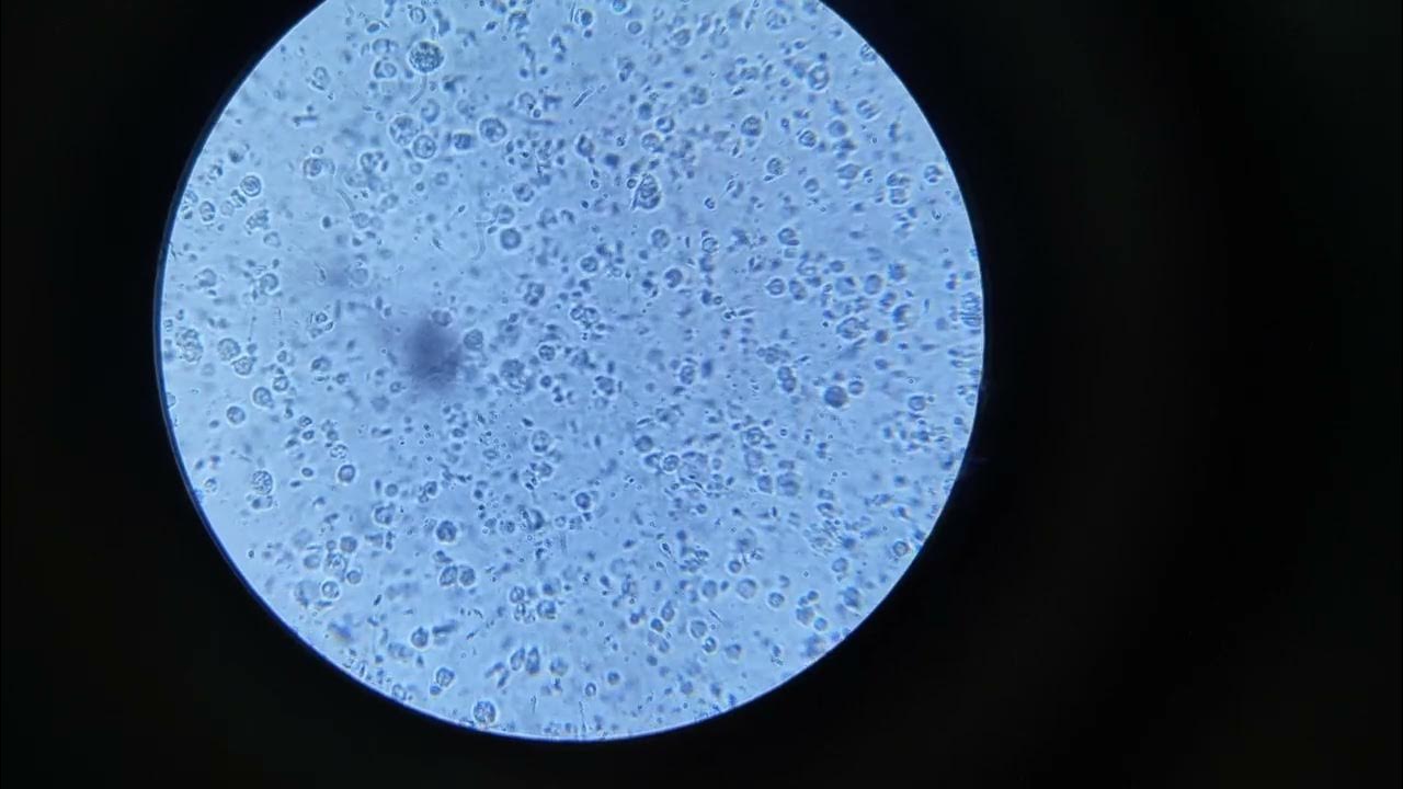 Plenty WBC Semen Analysis Slide - YouTube