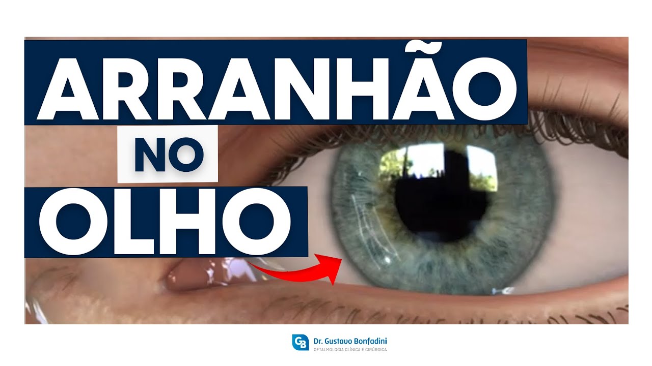 Globo Ocular Cortado Real Entenda A Diferença Entre Catarata E