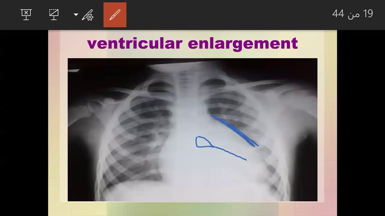 Cardio x. Ray 2 dr. Azhar - YouTube