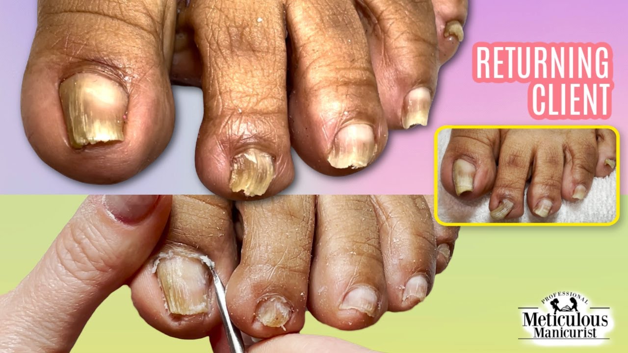 WAVY, Pincing, Nail Fungus TOENAIL Transformation Client RETURNS - YouTube