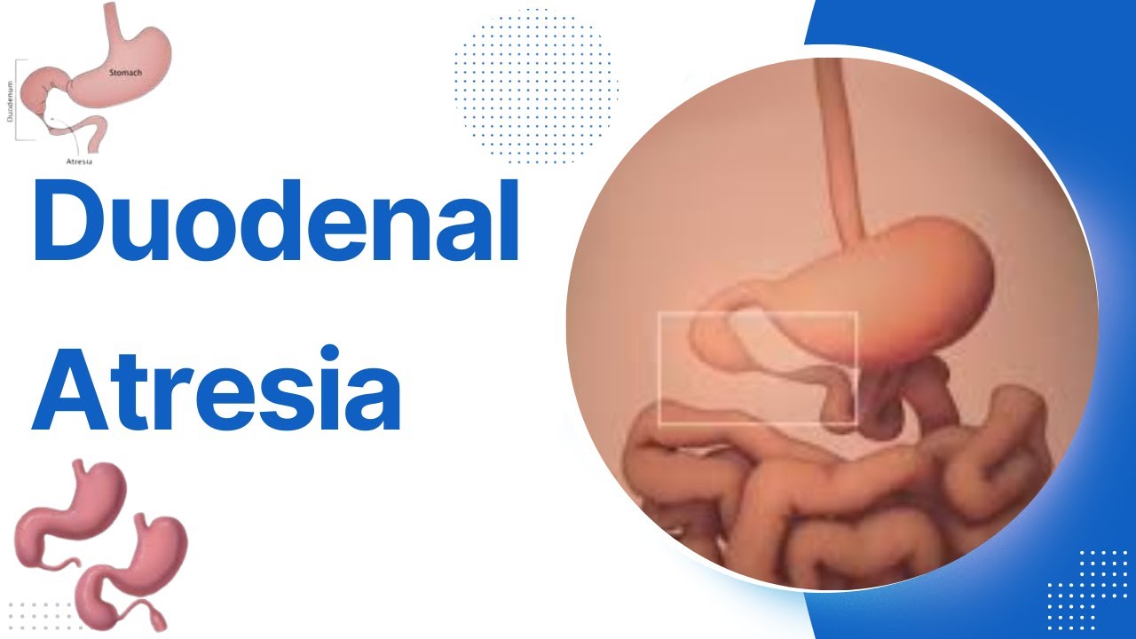 Duodenal Atresia : Causes, Clinical Features, Diagnosis and Management - YouTube