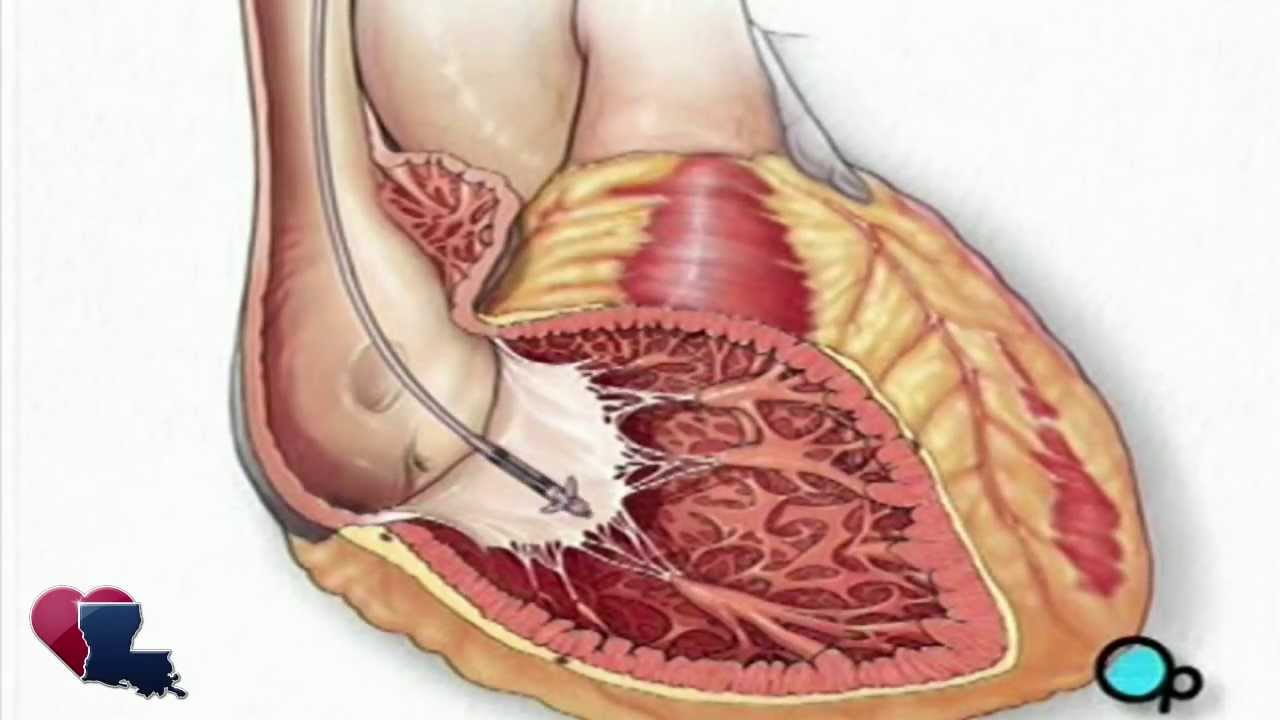 Permanent Pacemaker Implant Surgery - YouTube
