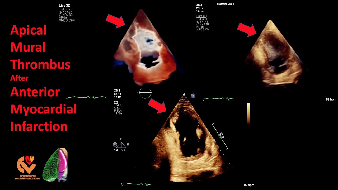 Apical Mural Thrombus after Anterior Myocardial Infarction - YouTube