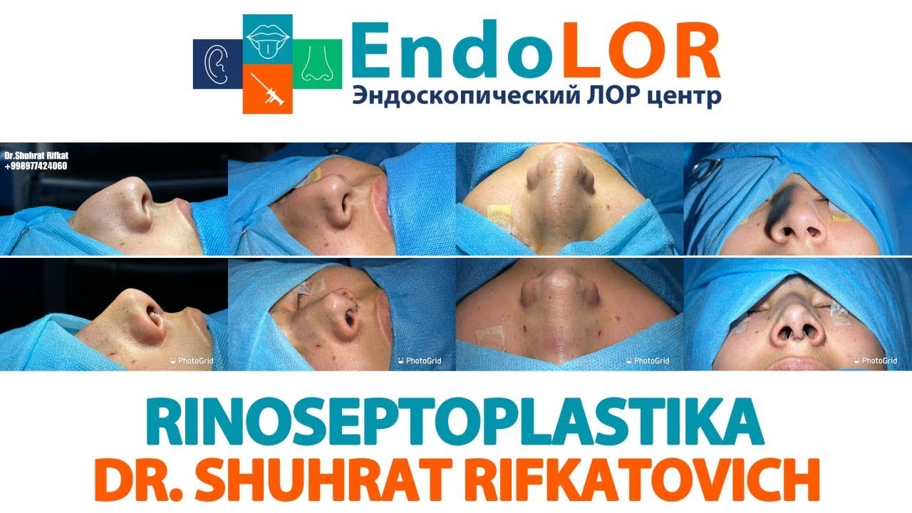 Риносептопластика Rinoseptoplastika jarrohlik amaliyoti - lor24.uz ...