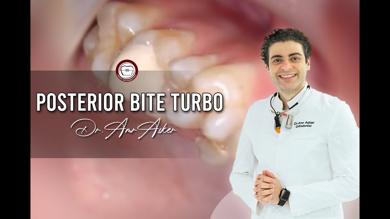 orthodontic bite turbo (bite raising- ramp-plane) fuji equia in cross ...