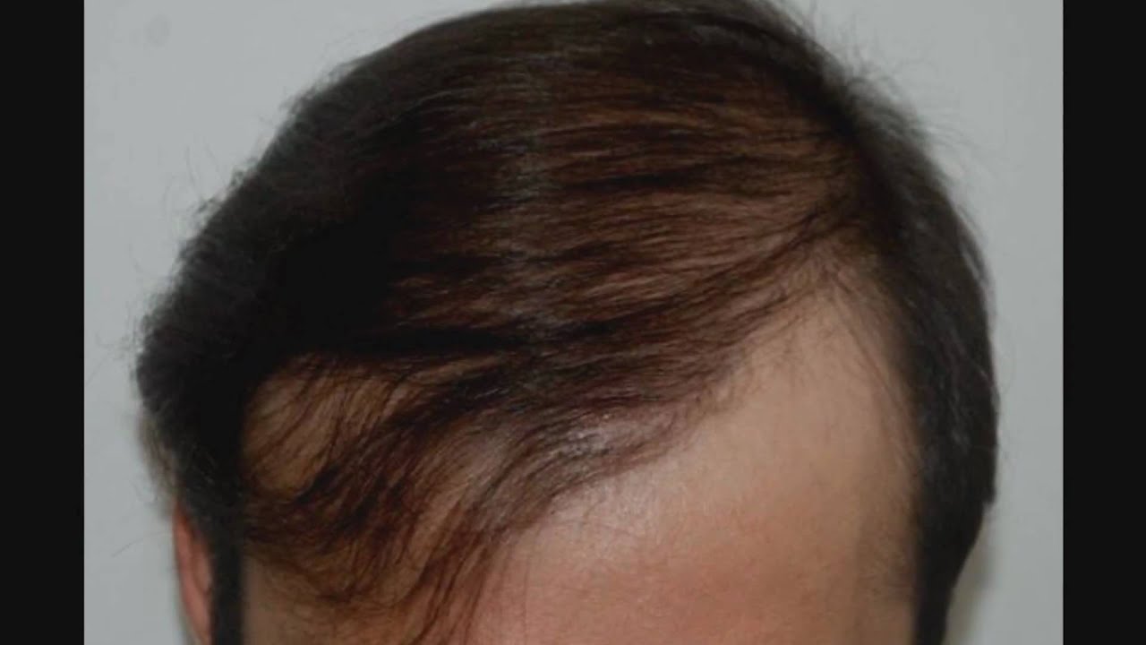 Trapianto Capelli. Il trapianto monobulbare. - YouTube