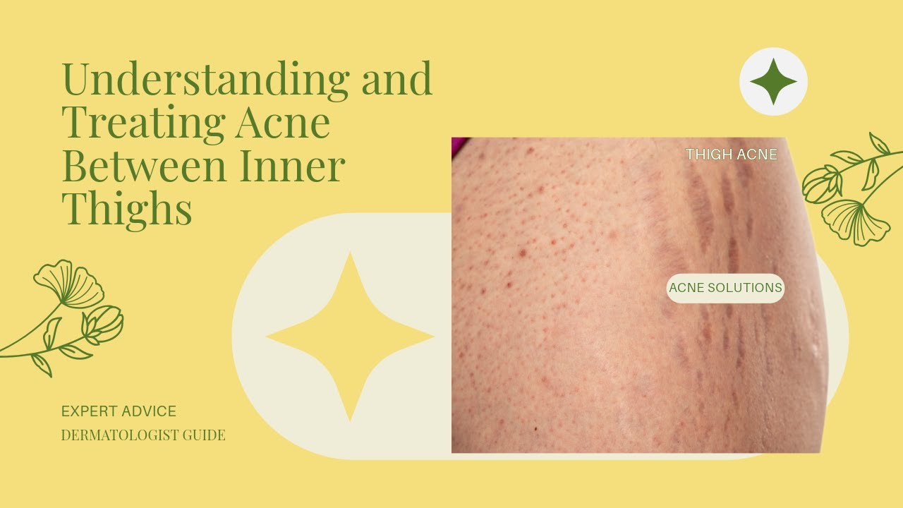 Understanding and Treating Acne Between Inner Thighs - YouTube