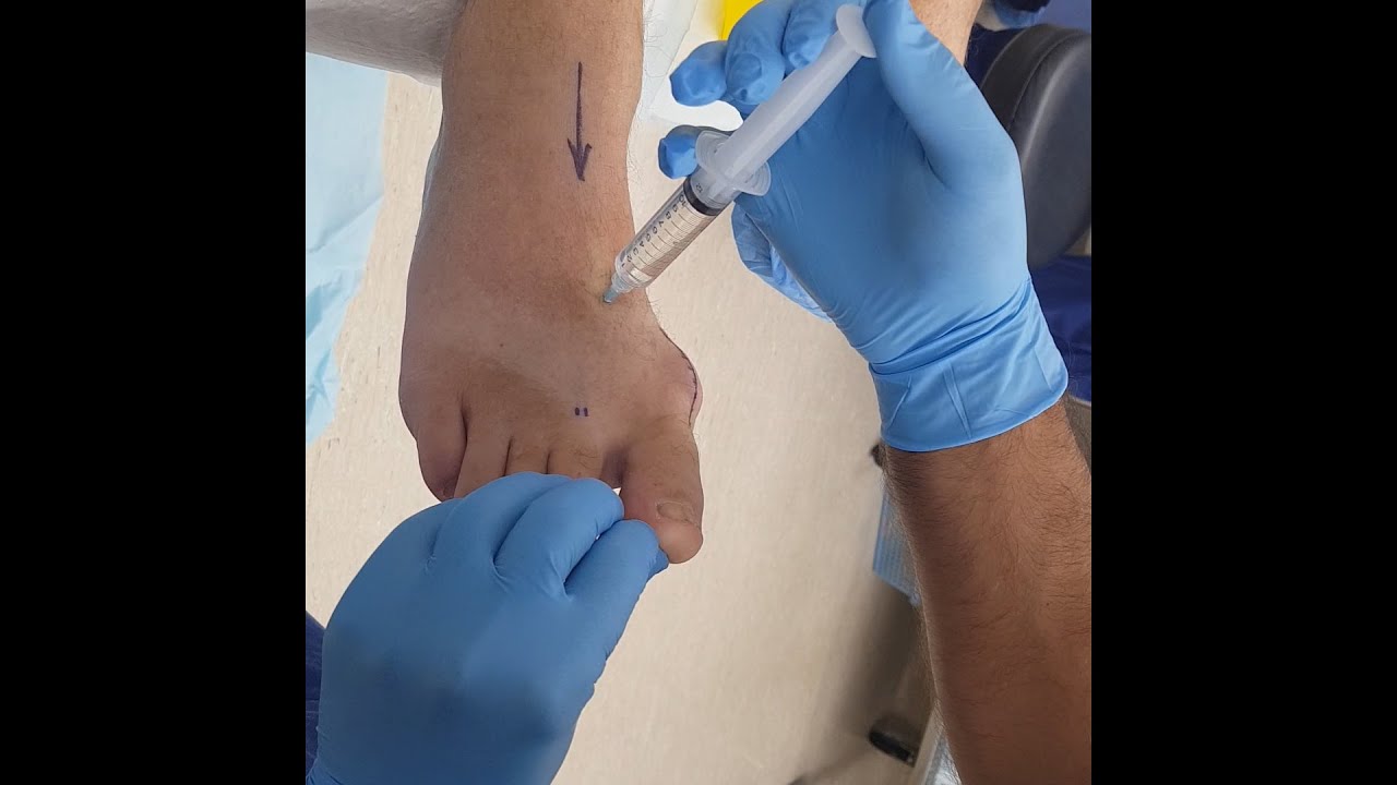 Nerve Anatomy of the 1st Metatarsal and the Mayo Block. - YouTube