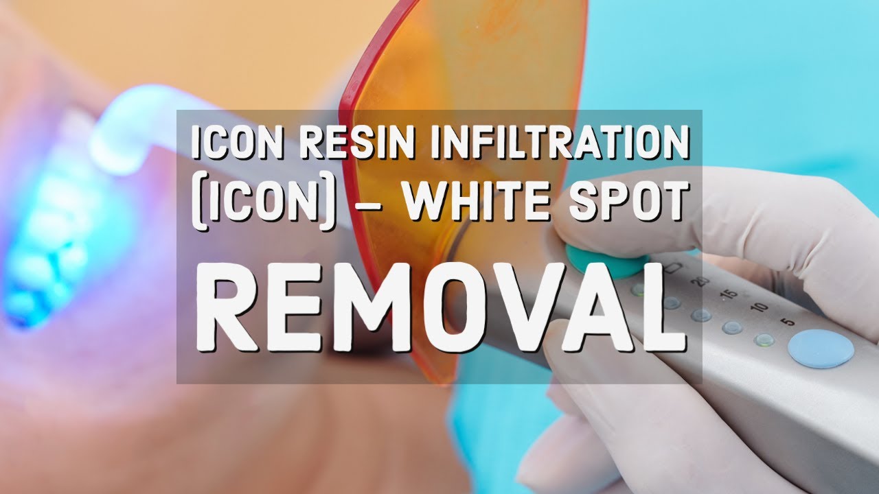 Icon Resin Infiltration (ICON) – White Spot Removal - YouTube